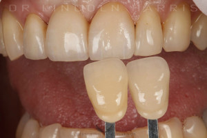 Replacing Pin/Lingual Retainer FPD