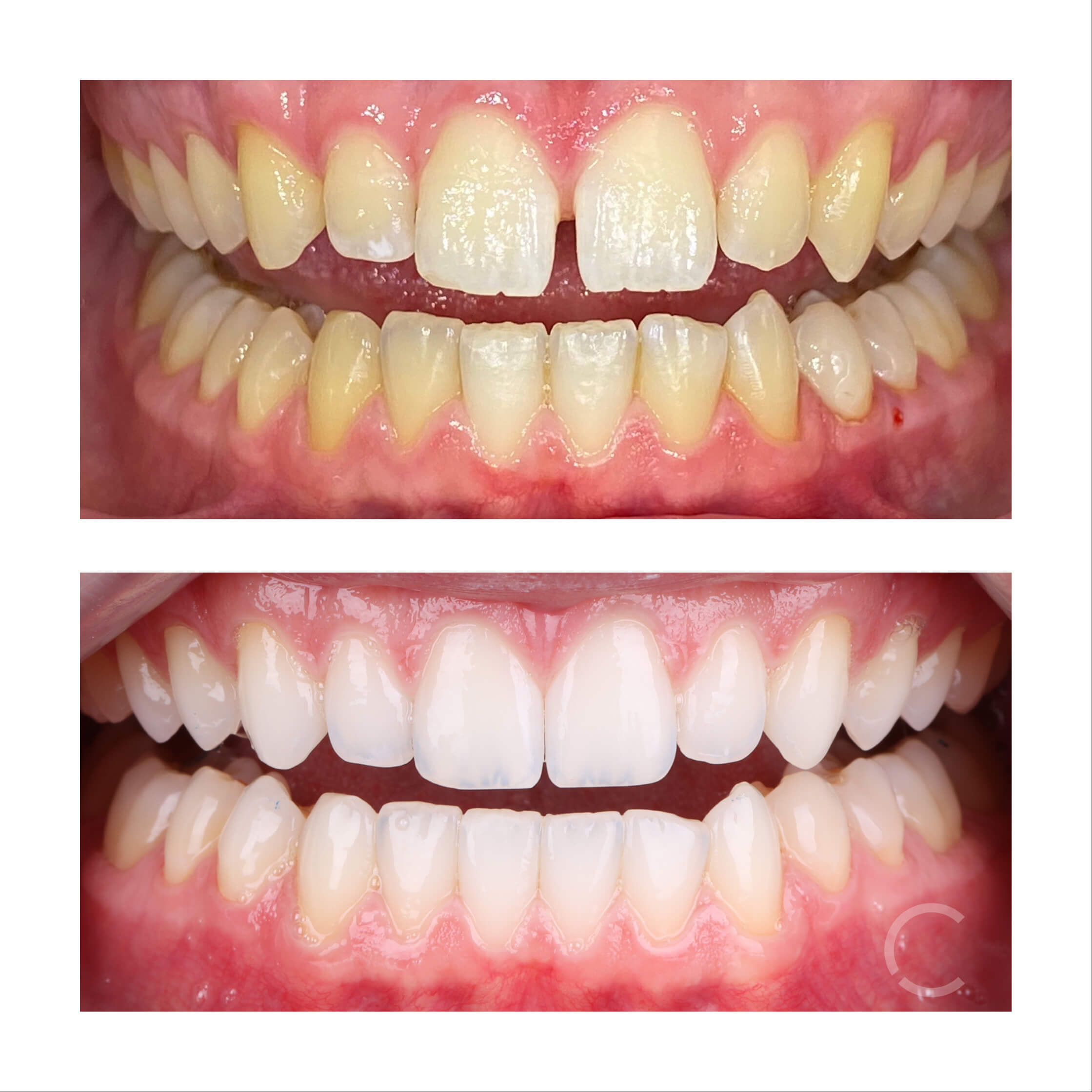 Complex Aligner Treatment Webinar with Dr Claudia Pinter