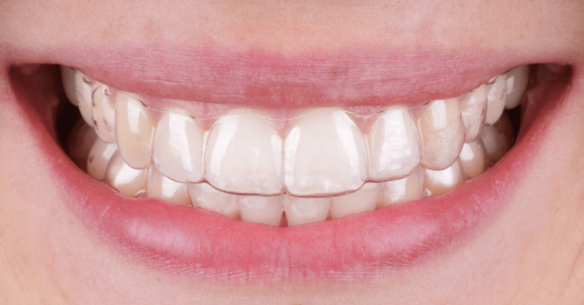 How to Get Started with Clear Aligner Therapy with Dr. Claudia Pinter