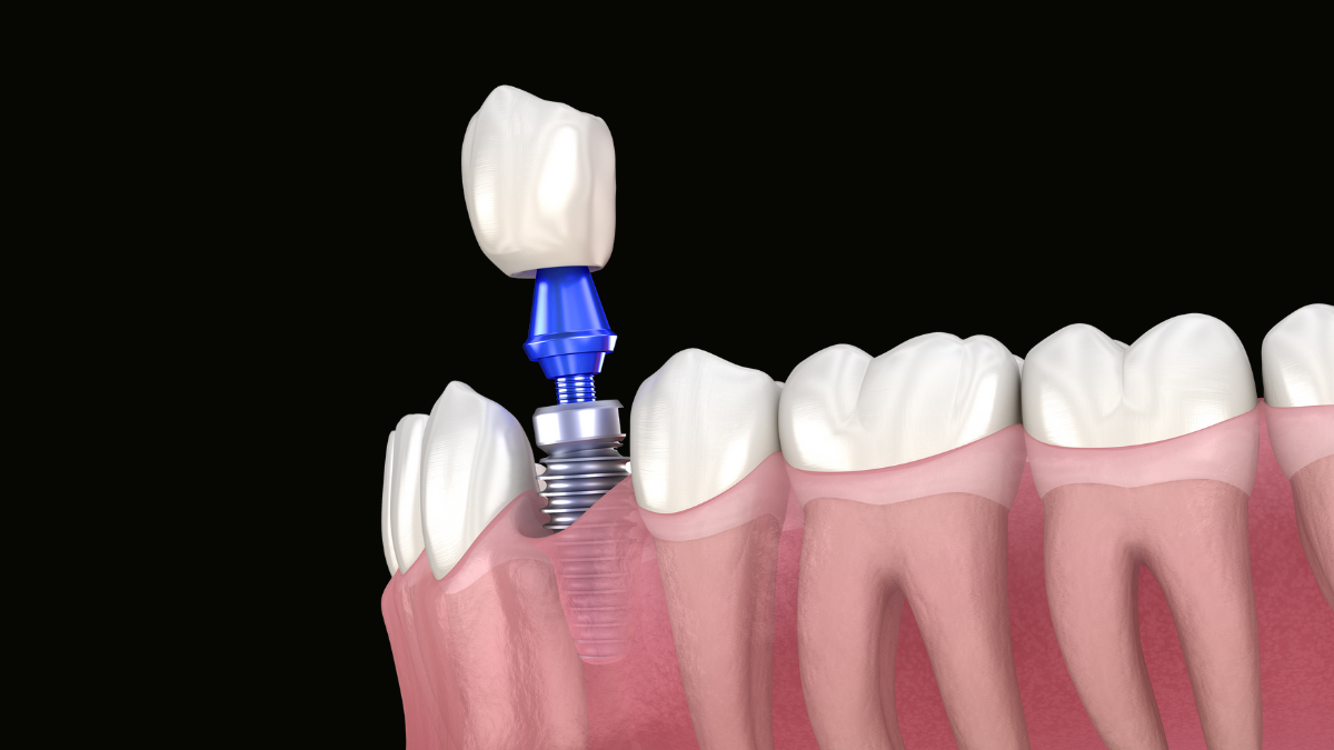 Modern Dental Implantology 101
